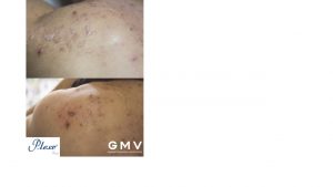 Plasma Pen: facciamo chiarezza! • Estetispa Academy