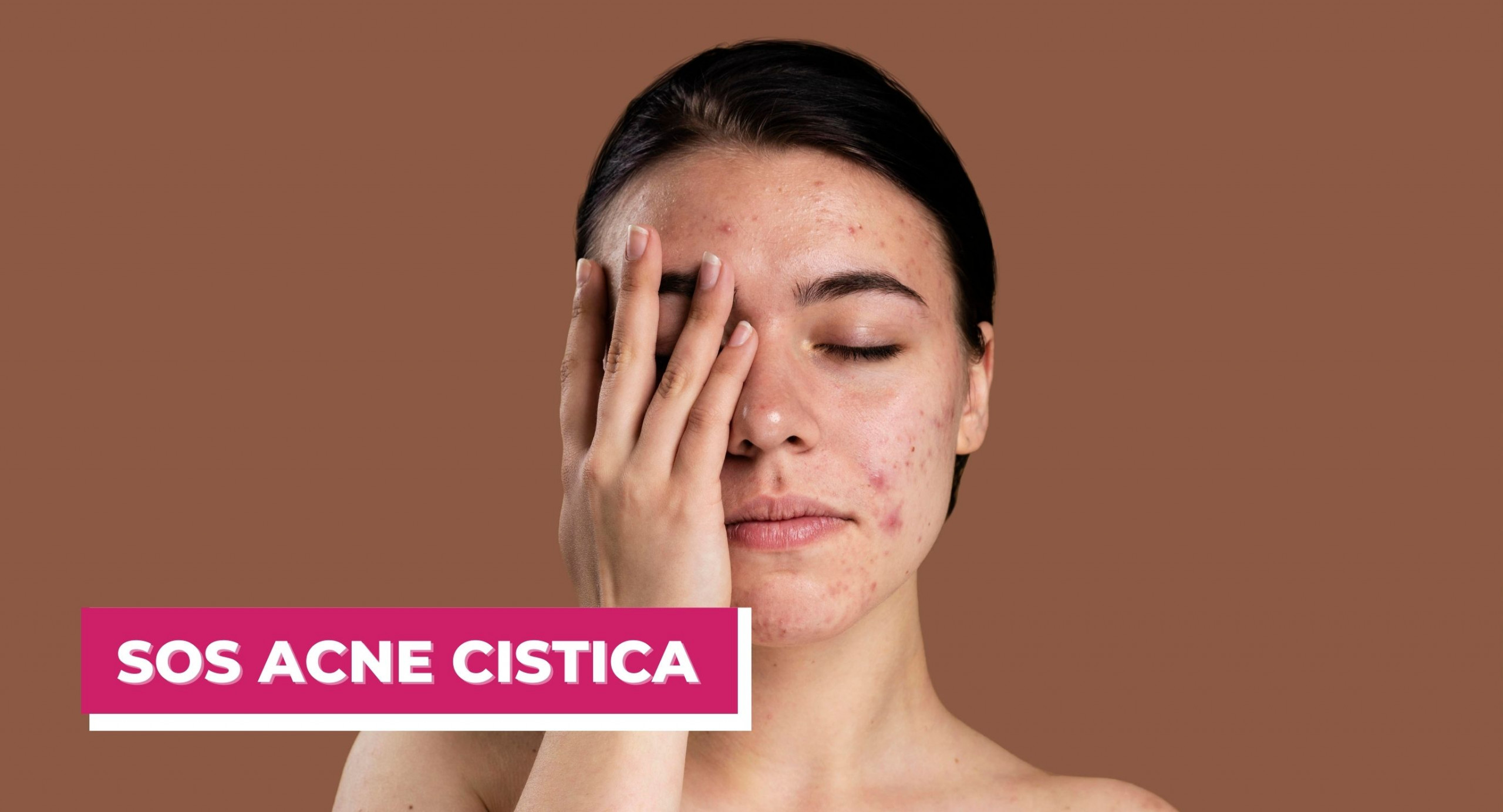 SOS acne cistica: fornisci la soluzione alle tue clienti